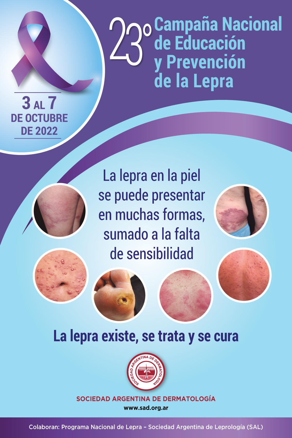 23° CAMPAÑA NACIONAL DE EDUCACIÓN Y PREVENCIÓN DE LA LEPRA – SAD