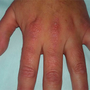 Dermatomiositis – SAD